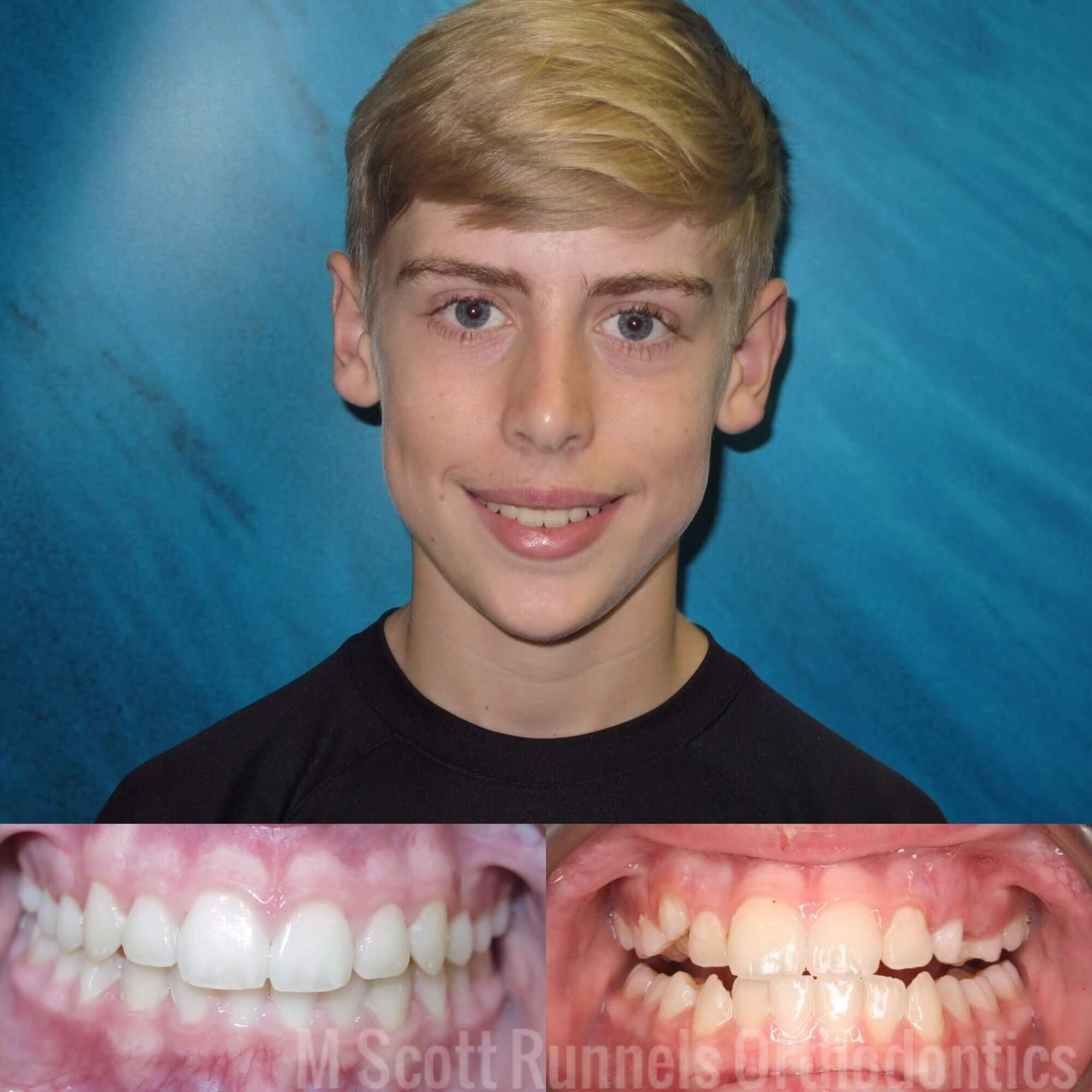 Before & After | Runnels Orthodontics