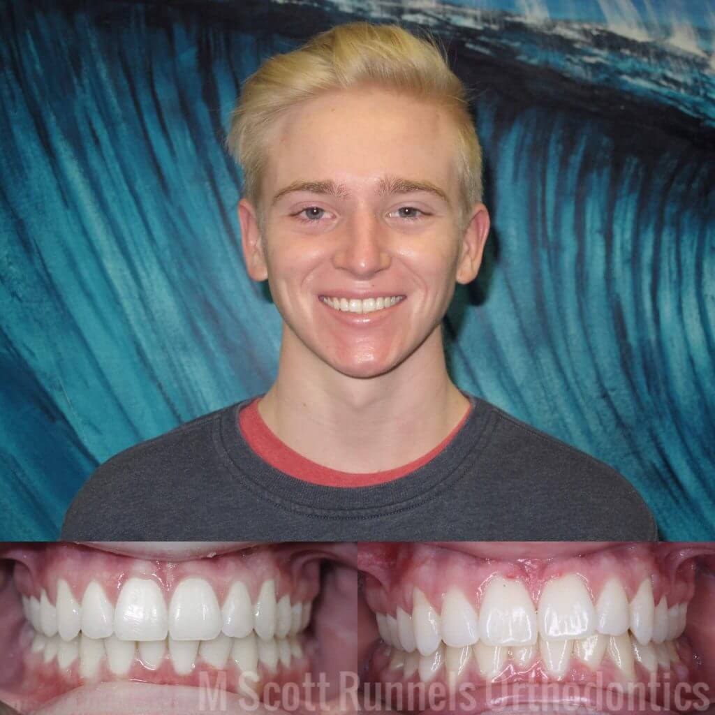Before & After | Runnels Orthodontics
