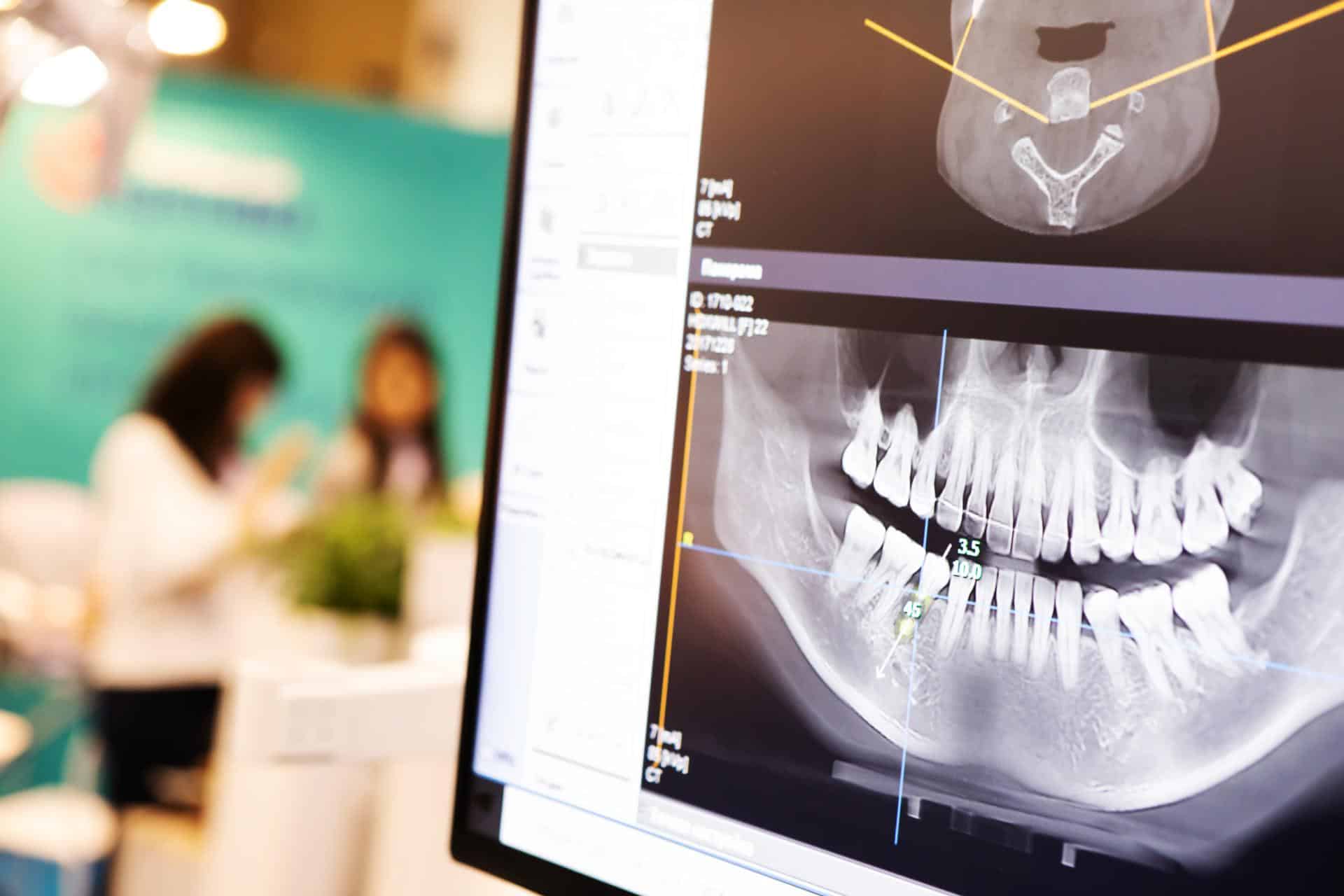 Jaw Surgery vs. Braces Alone: How Orthodontists Decide the Best Path ...